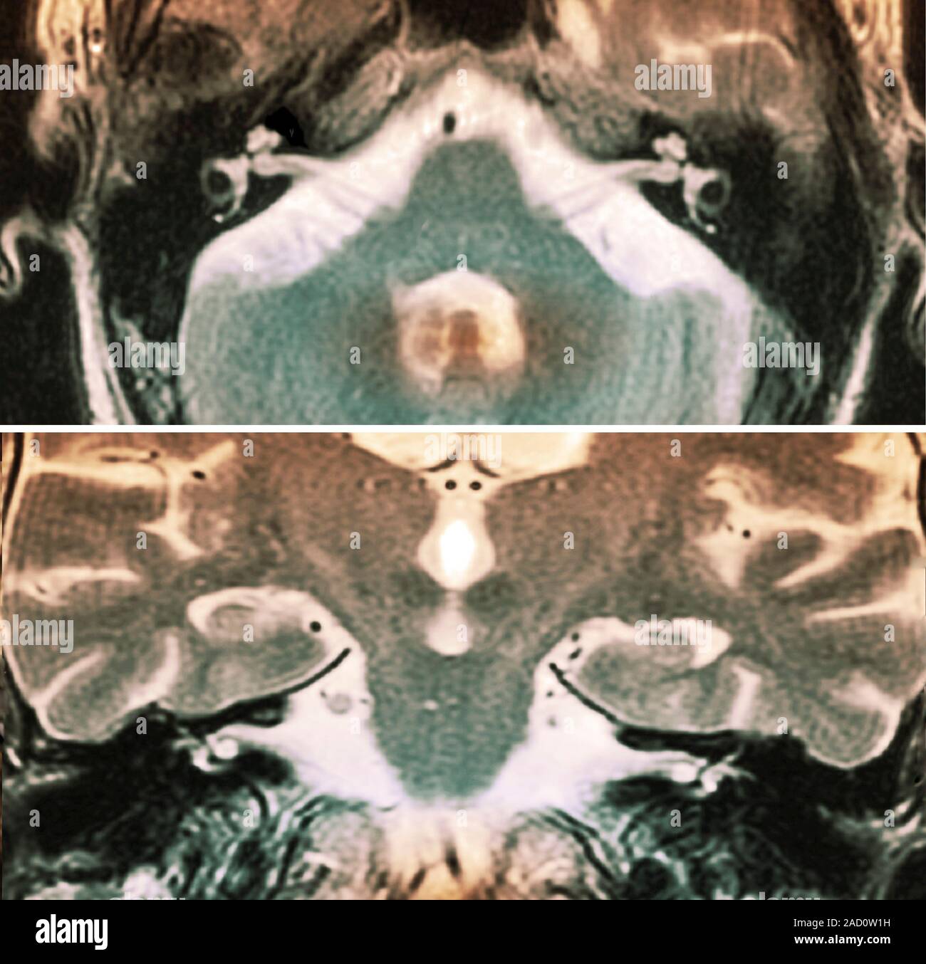 Auditory system. Coloured magnetic resonance imaging (MRI) scans of ...
