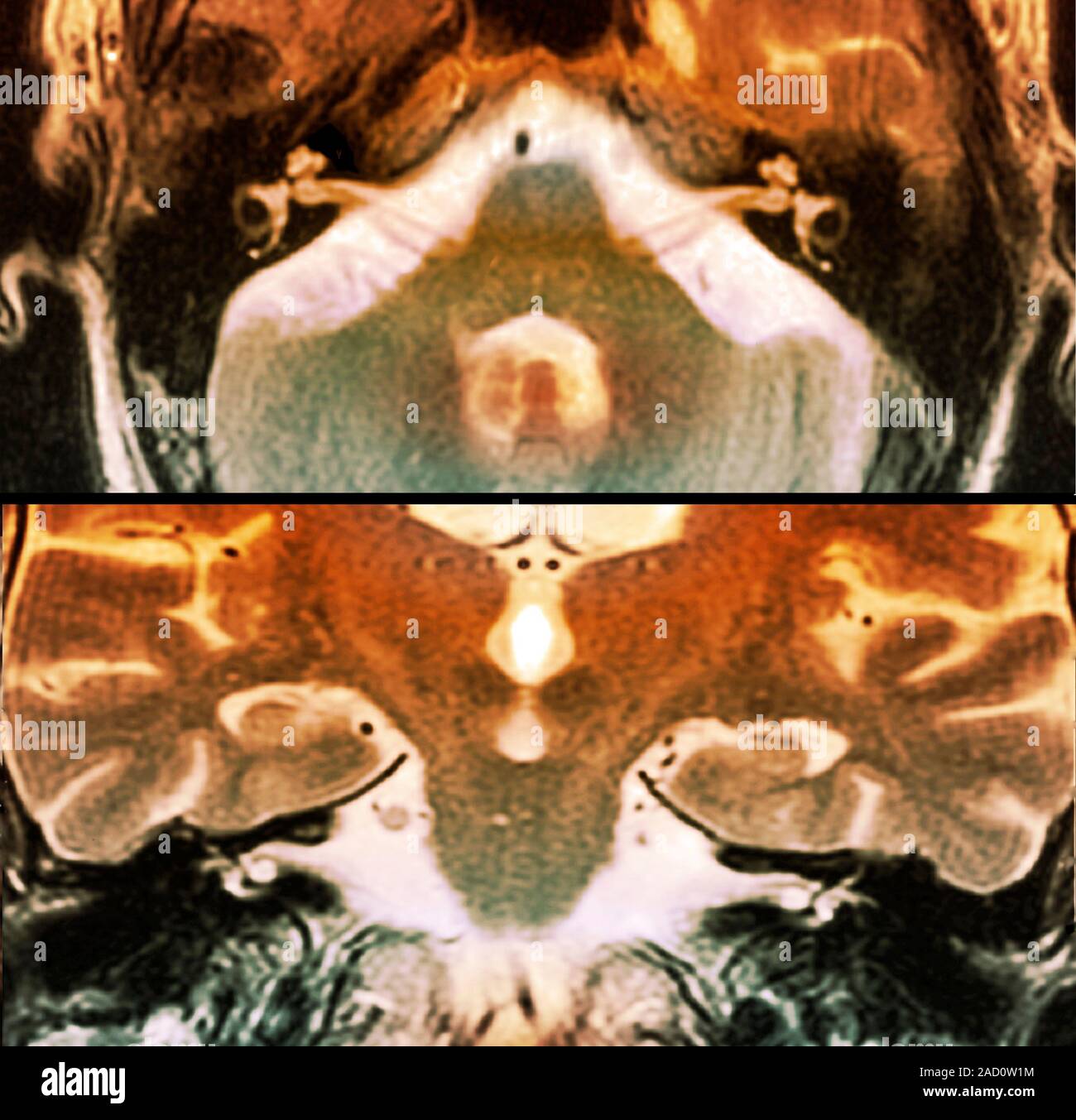 Auditory system. Coloured magnetic resonance imaging (MRI) scans of ...