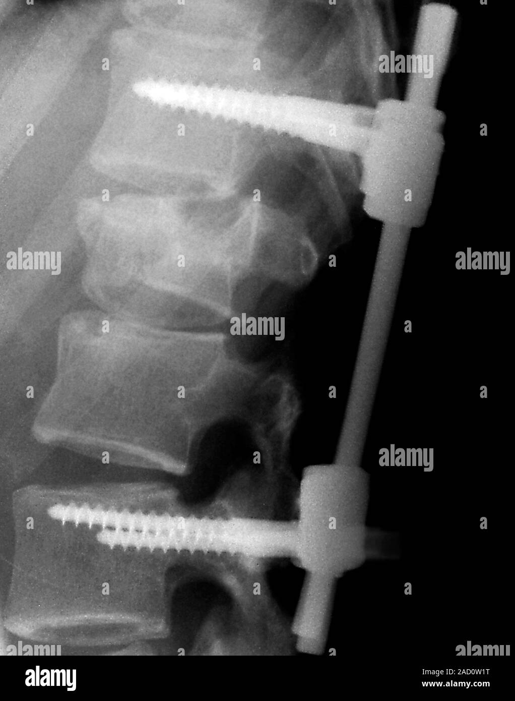 Pinned backbone. X-ray of a section through the back of a 28-year-old ...