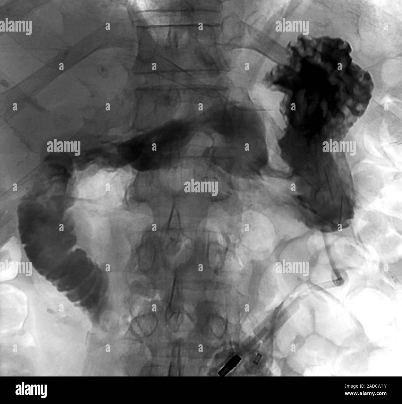 Stomach feeding tube in cancer. Fluoroscopic X-ray image of a section ...
