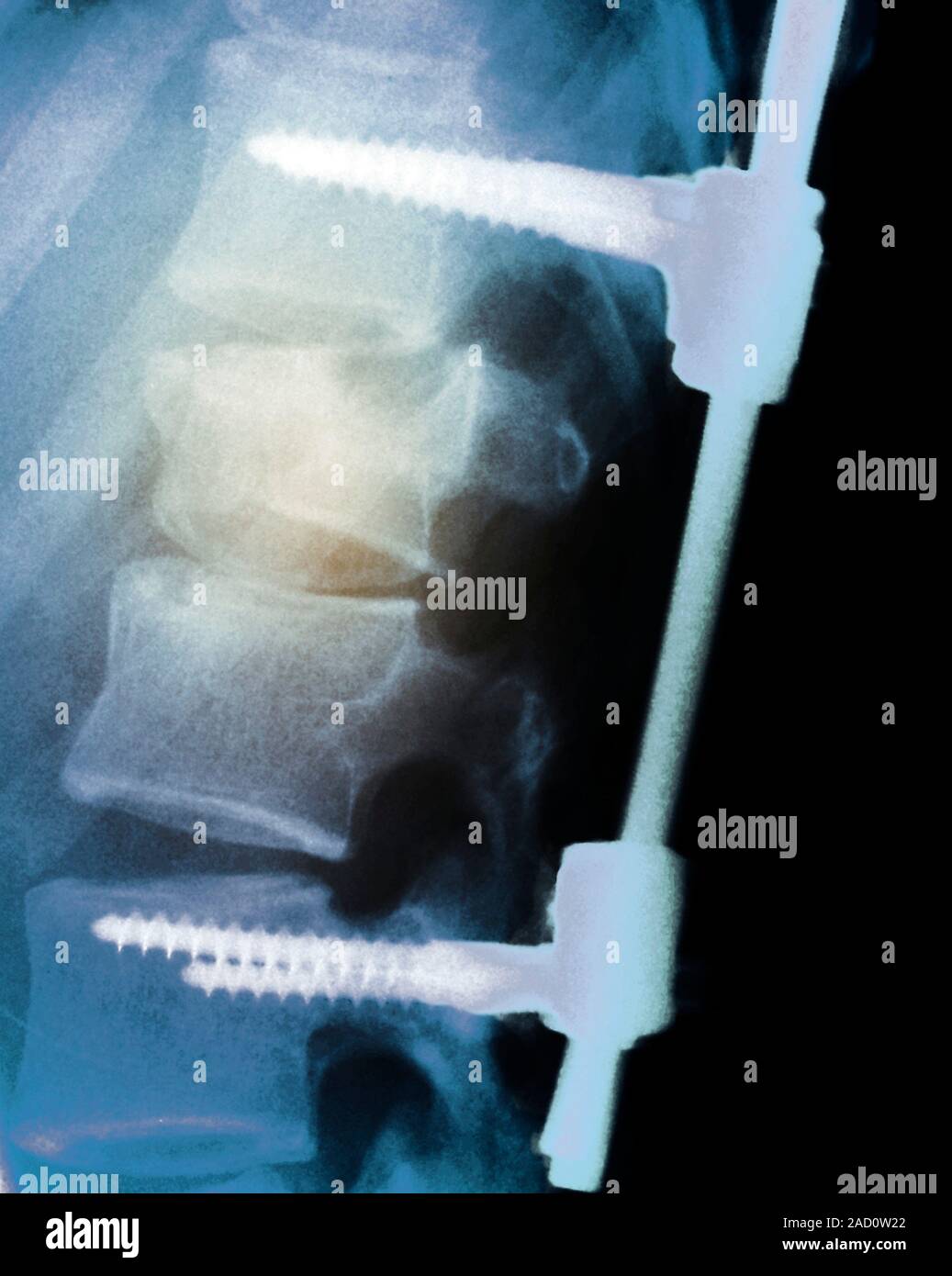 Pinned backbone. Coloured X-ray of a section through the back of a 28 ...