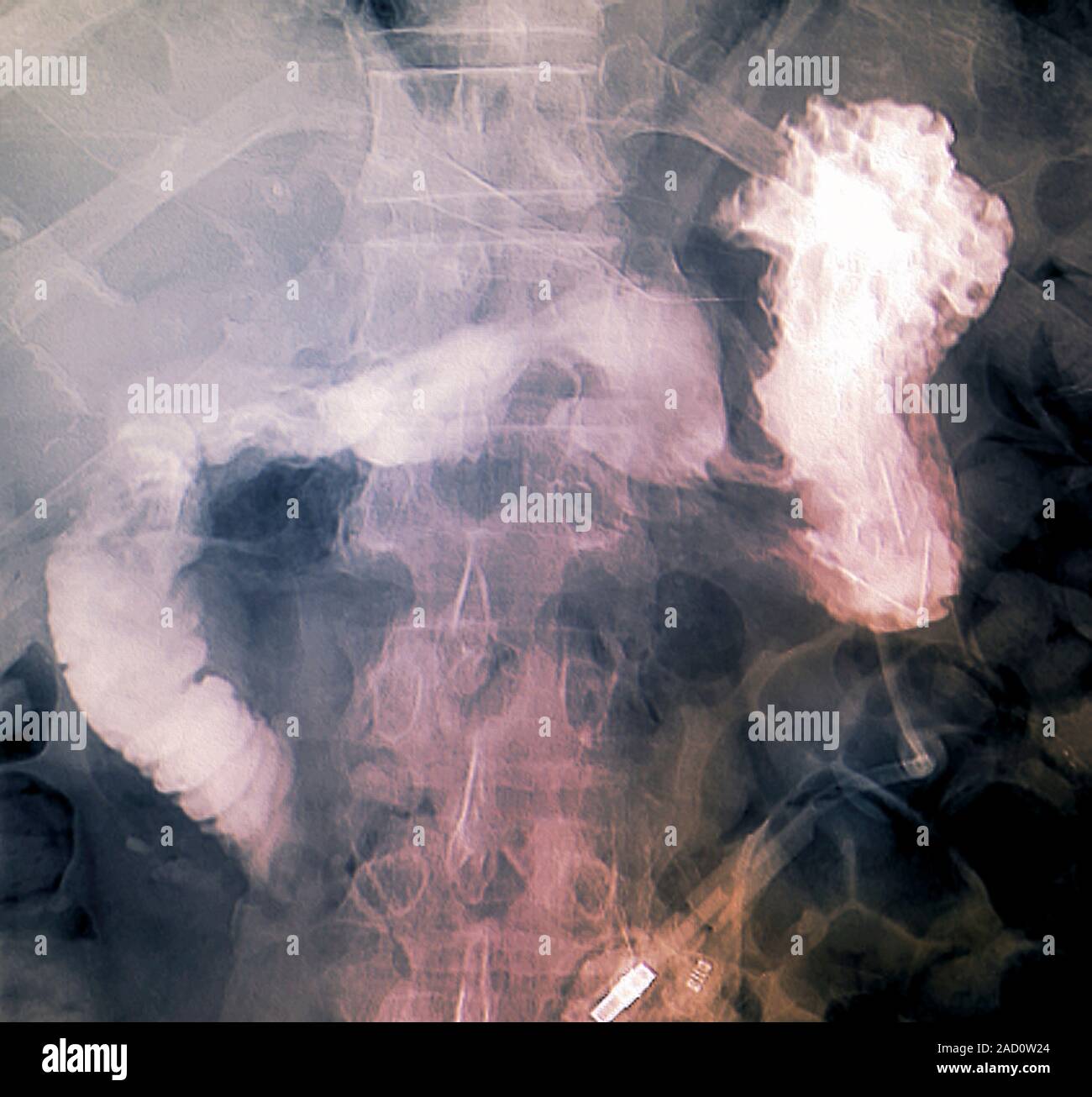 Stomach feeding tube in cancer. Coloured fluoroscopic X-ray image of a ...