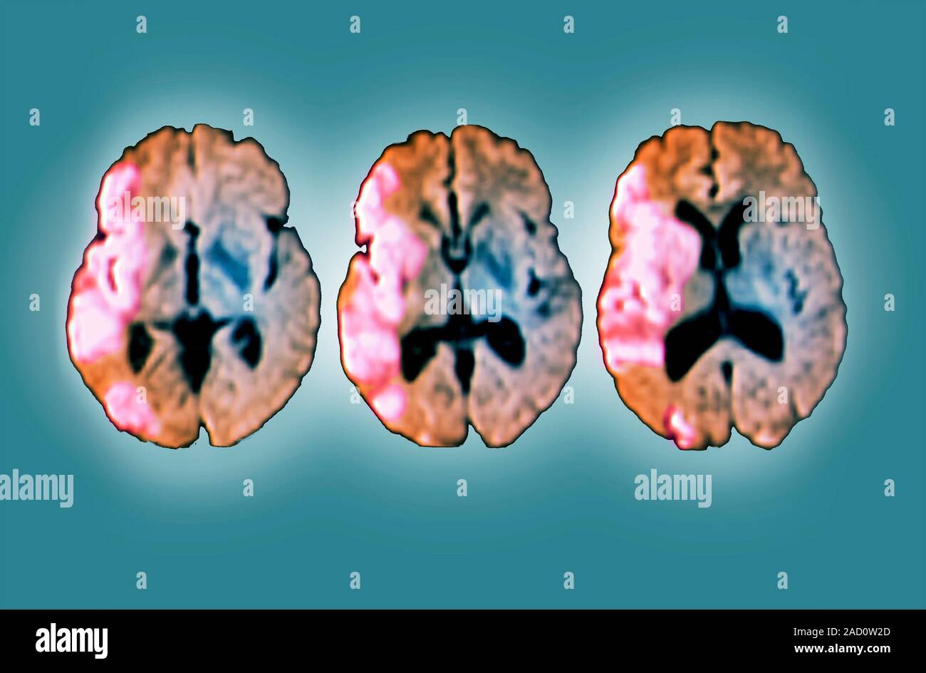 Brain in ischemic stroke. Coloured magnetic resonance imaging (MRI ...