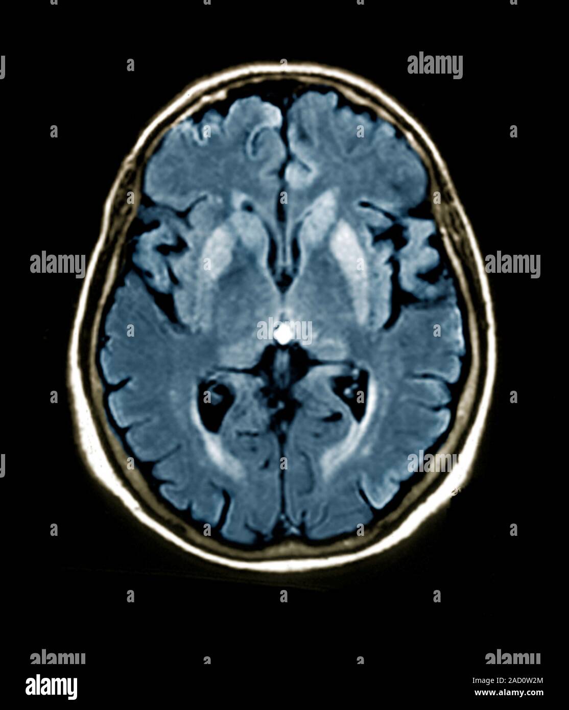 Brain in Creutzfeldt-Jakob disease. FLAIR magnetic resonance imaging ...