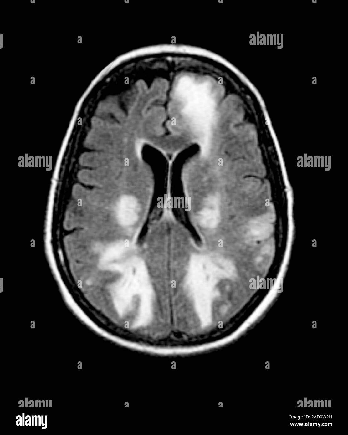 Brain in toxic encephalopathy. FLAIR magnetic resonance imaging (MRI ...