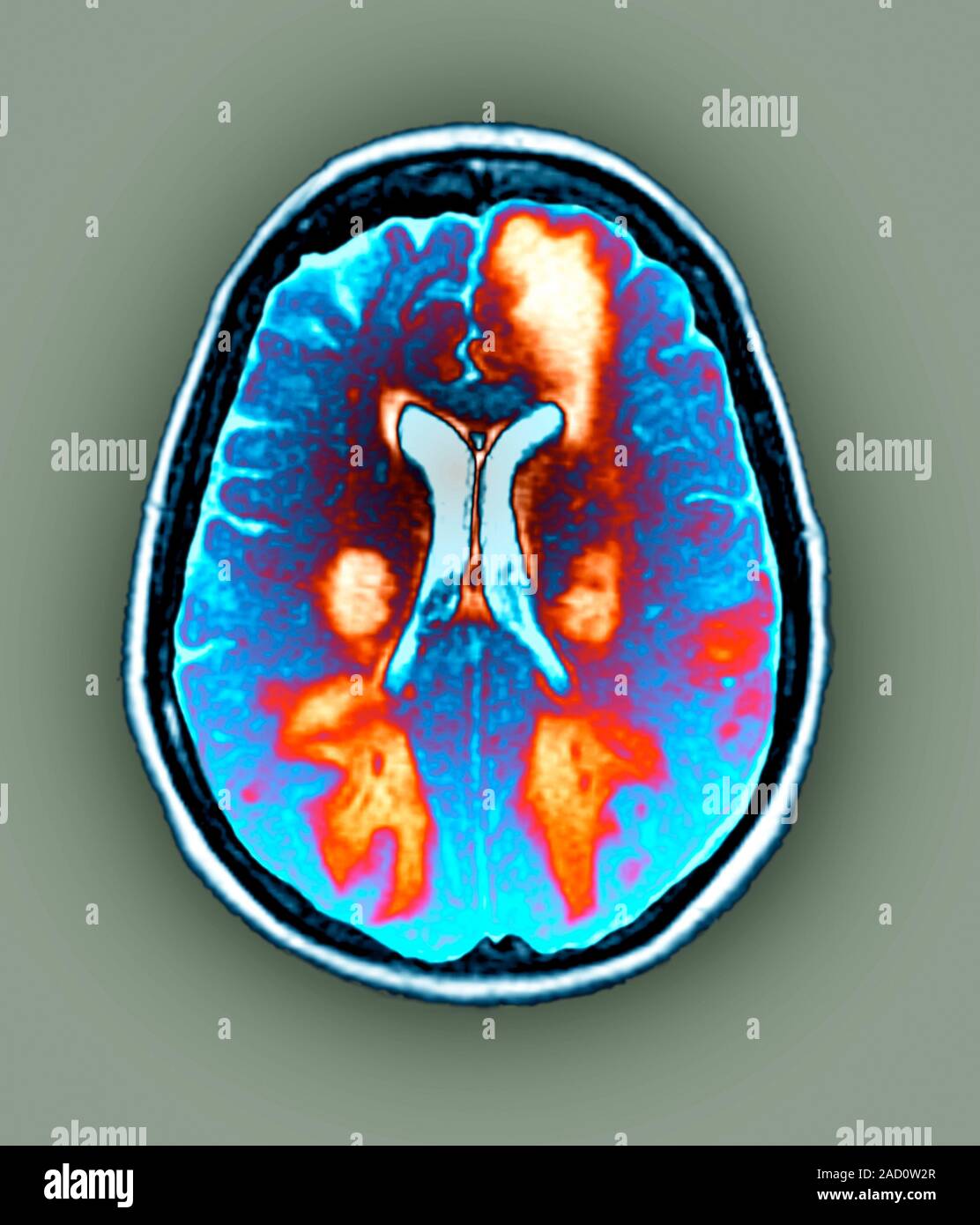 Brain in toxic encephalopathy. FLAIR magnetic resonance imaging (MRI ...
