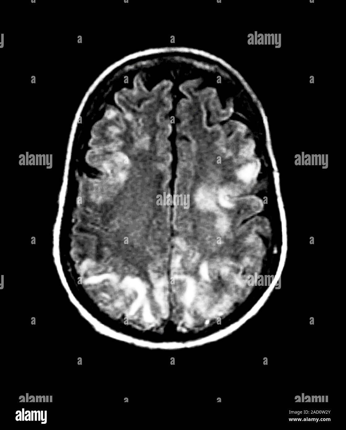 Brain in toxic encephalopathy. FLAIR magnetic resonance imaging (MRI ...