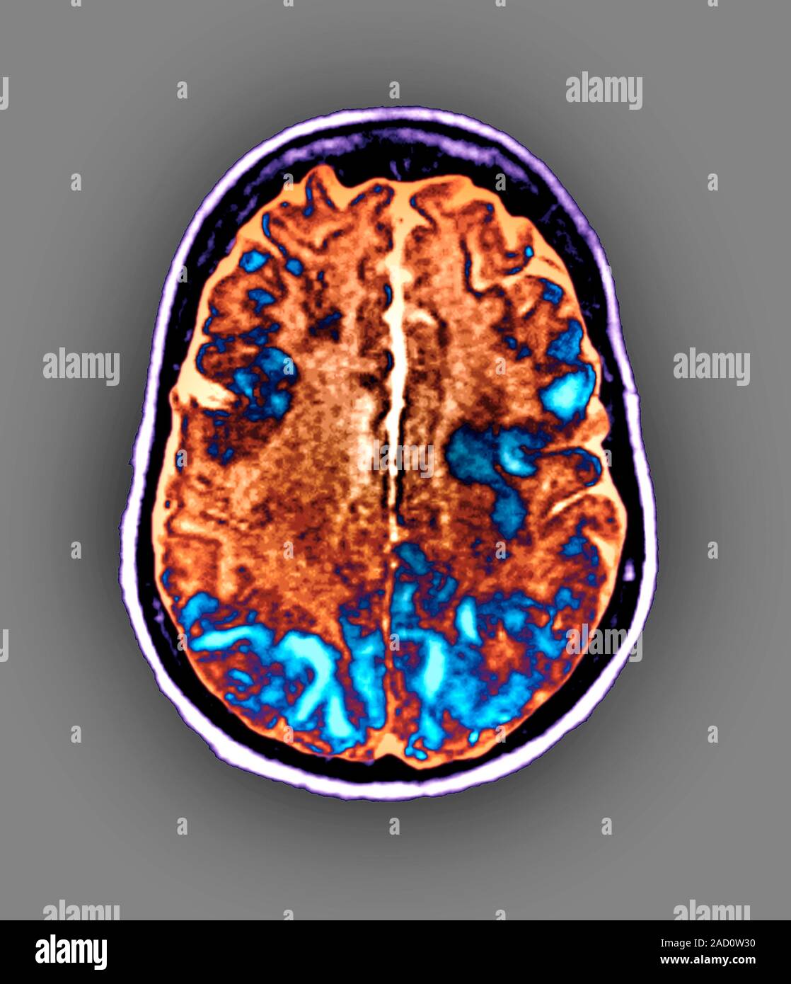 Brain in toxic encephalopathy. FLAIR magnetic resonance imaging (MRI ...