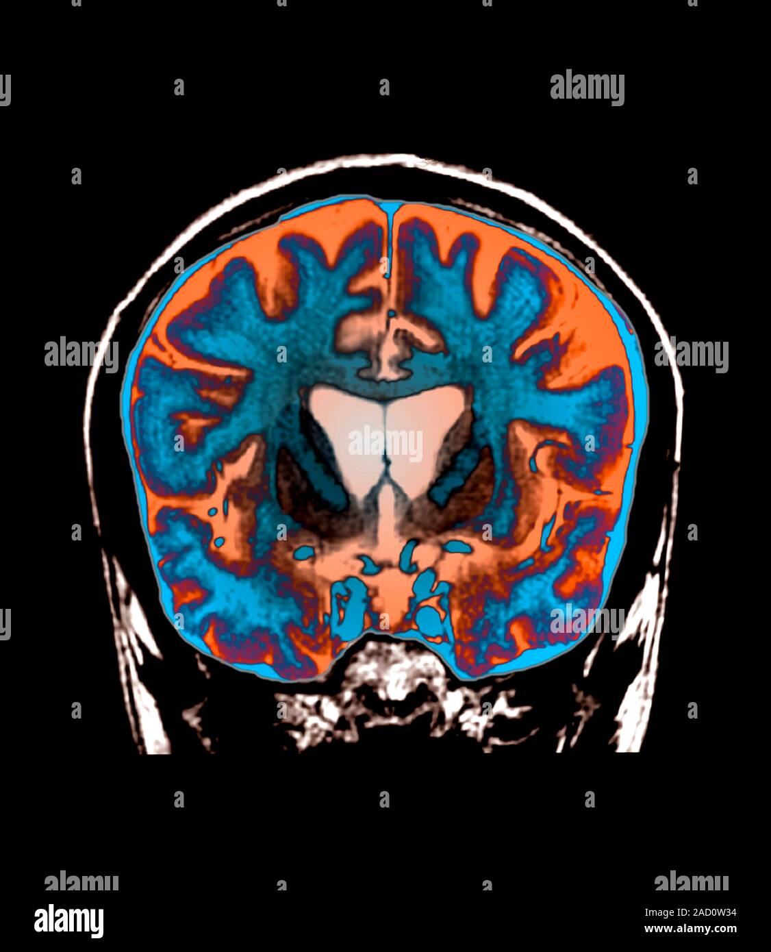 Brain in Huntington's disease. FLAIR magnetic resonance imaging (MRI ...