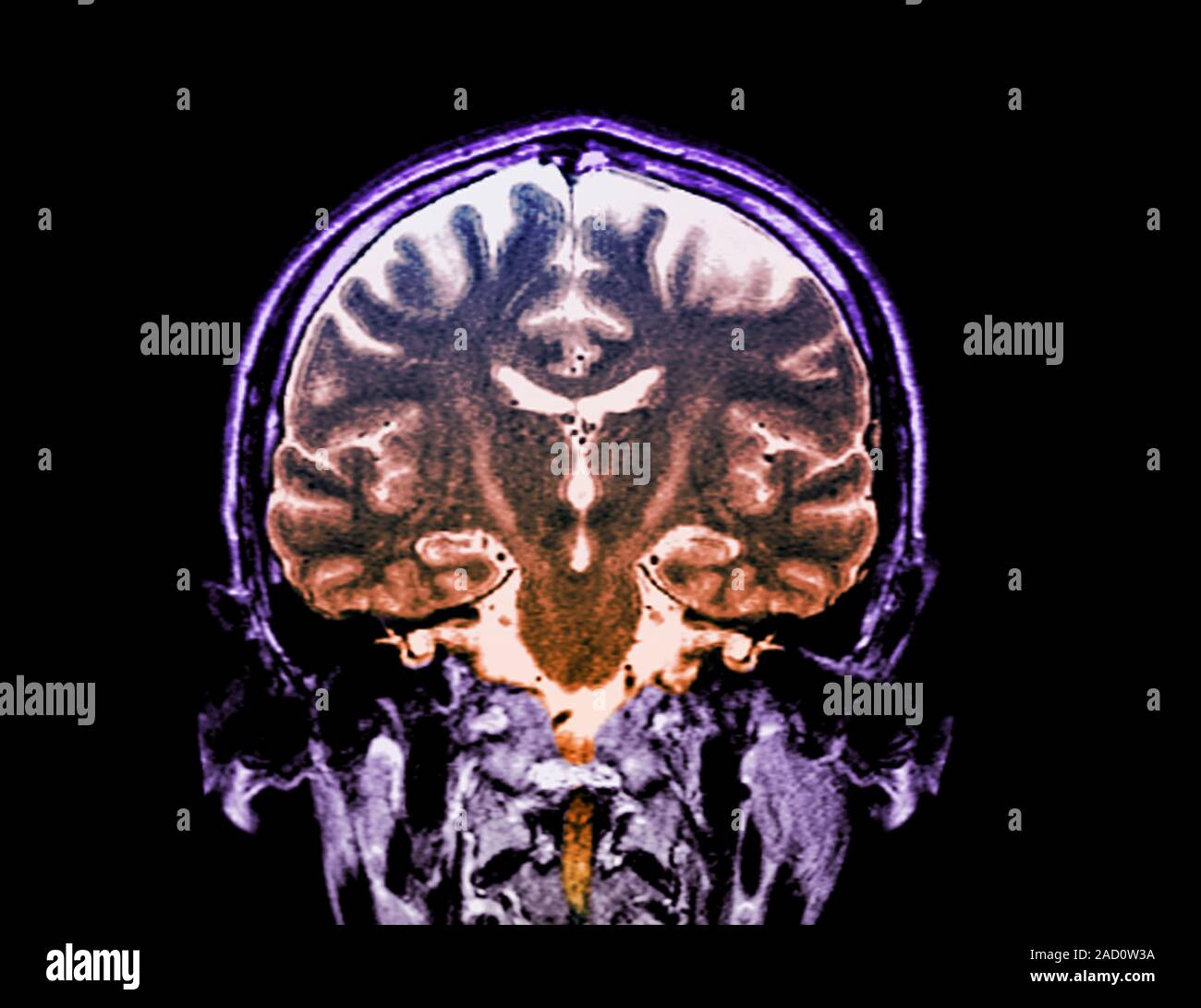Brain in motor neurone disease. FLAIR magnetic resonance imaging (MRI ...