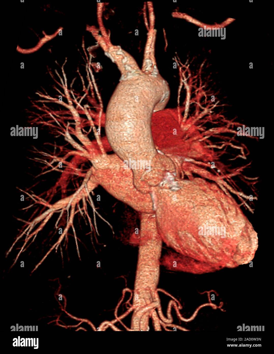Aortic aneurysm in hypertension. Coloured 3D computed tomography (CT) scan of the chest of a 53 ...