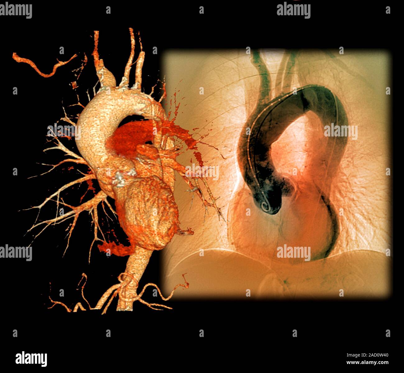 Aortic aneurysm in hypertension. Coloured angiogram (right) and 3D computed tomography scan ...