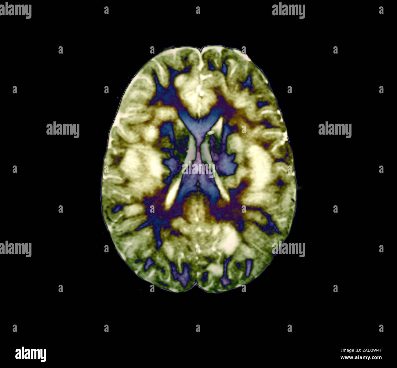 Acute disseminated encephalomyelitis. Coloured magnetic resonance ...