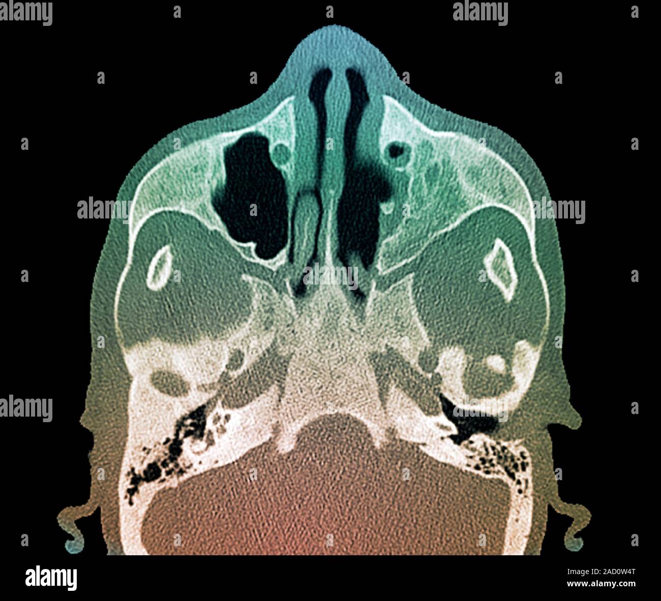Bone damage in hyperparathyroidism. Coloured magnetic resonance imaging ...