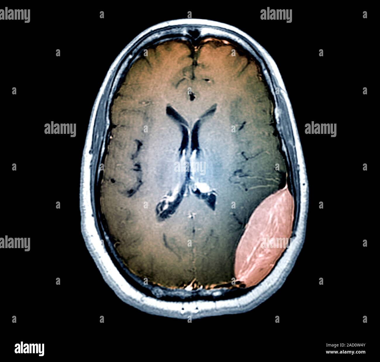 Brain cancer. Coloured magnetic resonance imaging (MRI) scan of an axial section through the ...