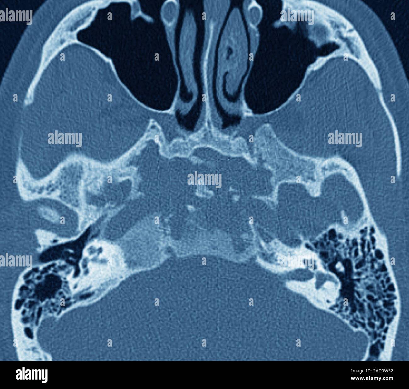 Skull in Erdheim-Chester disease. Coloured computed tomography (CT ...