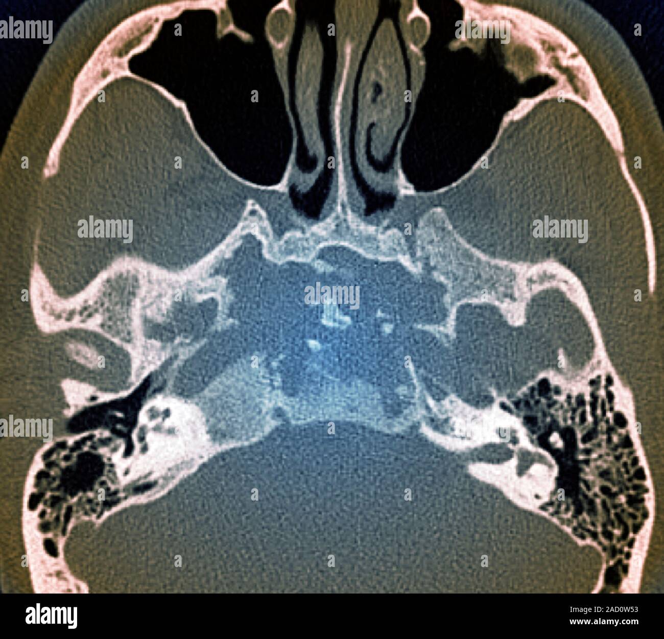 Skull in Erdheim-Chester disease. Coloured computed tomography (CT ...