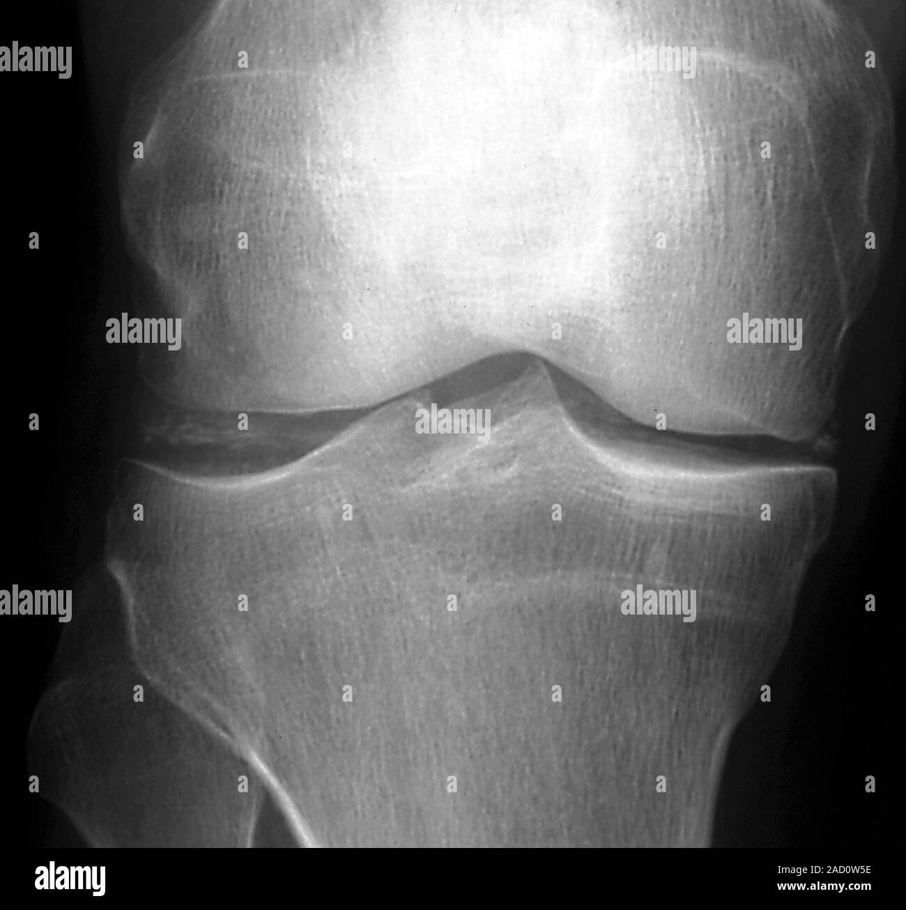 Calcification in the knee. X-ray of a section through the knee of a 40 ...