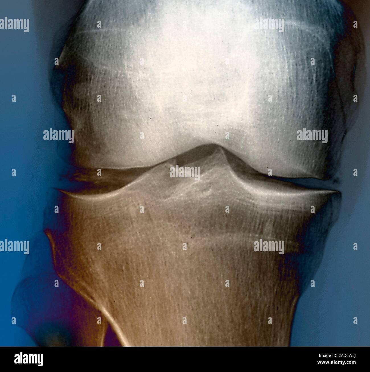 Calcification in the knee. Coloured X-ray of a section through the knee ...