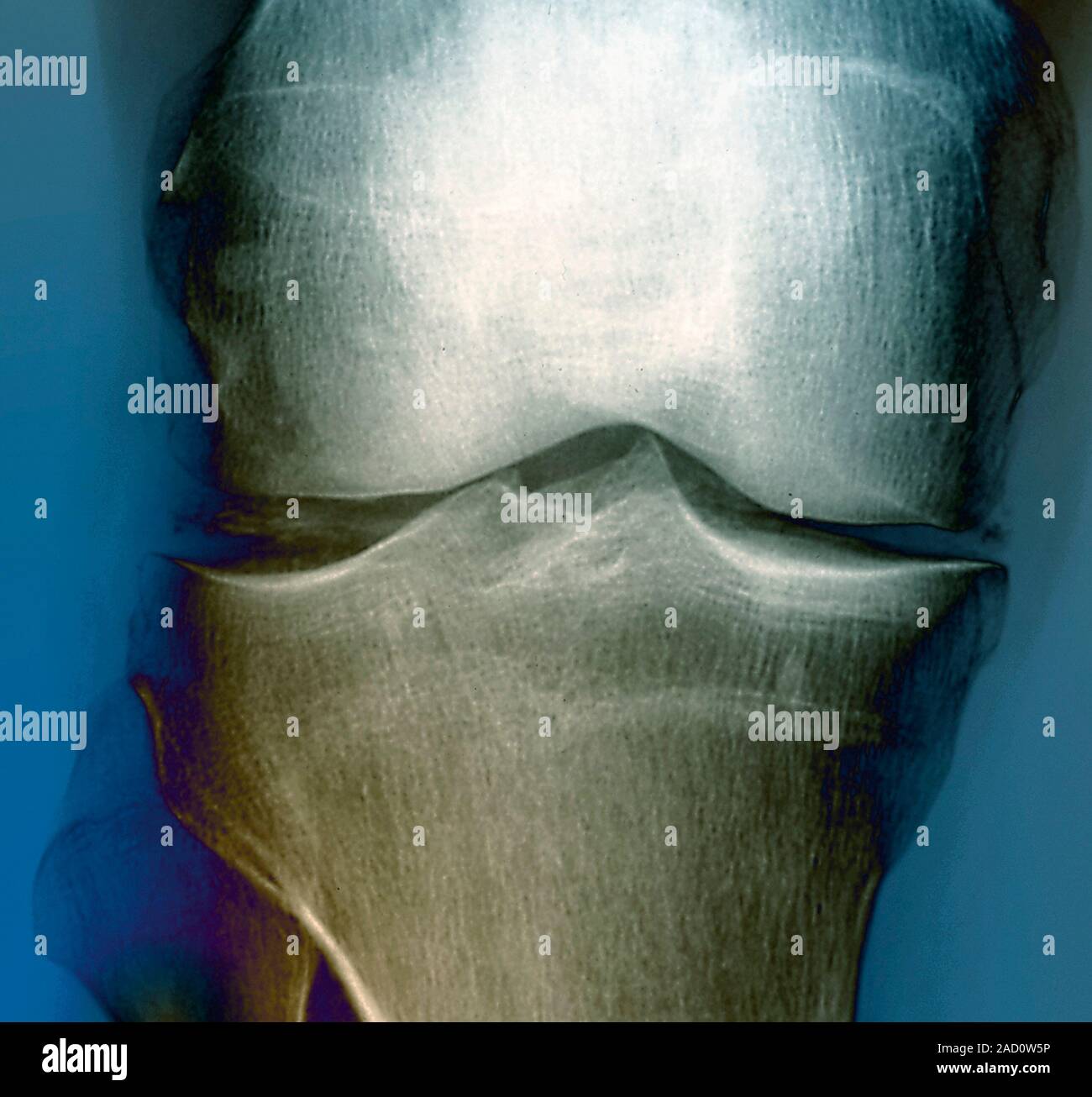 Calcification in the knee. Coloured X-ray of a section through the knee ...