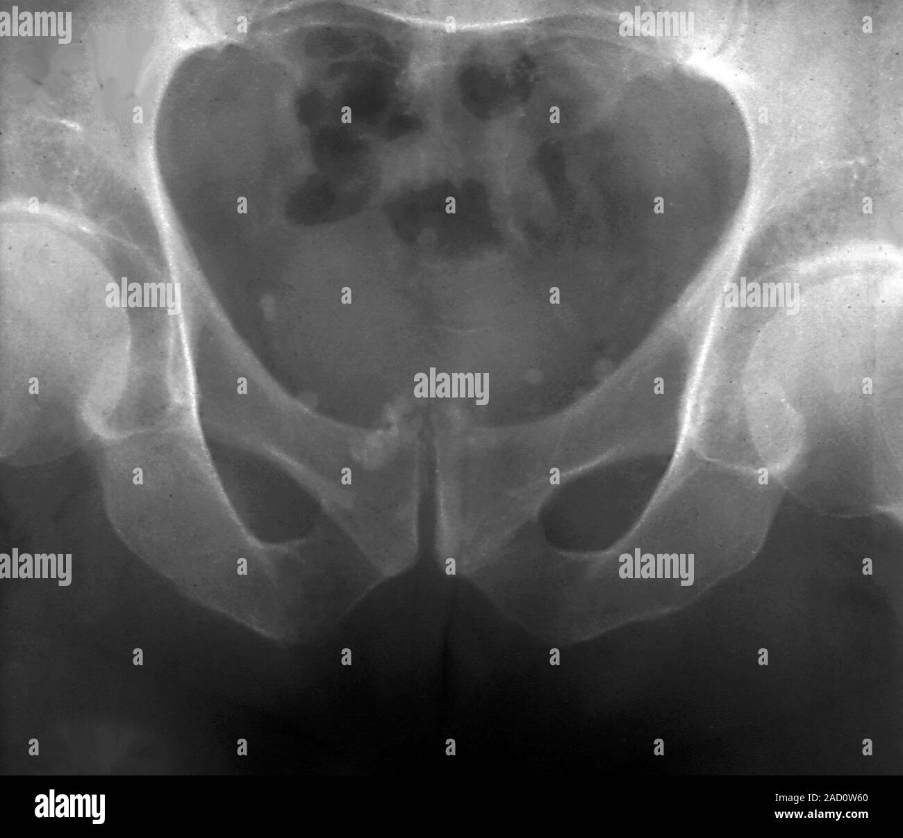 Benign prostatic hyperplasia. X-ray of a section through the pelvis of ...