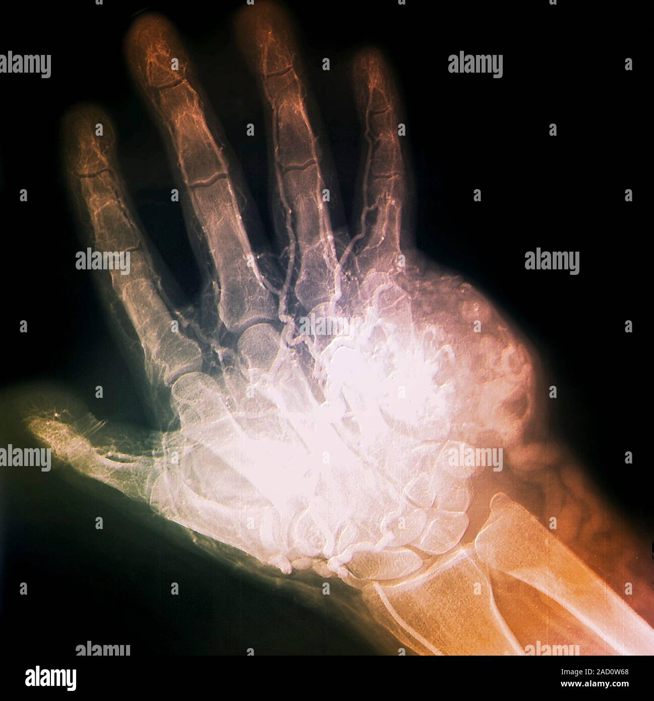 Hand tumour, X-ray. Coloured angiogram of a section through the swollen ...