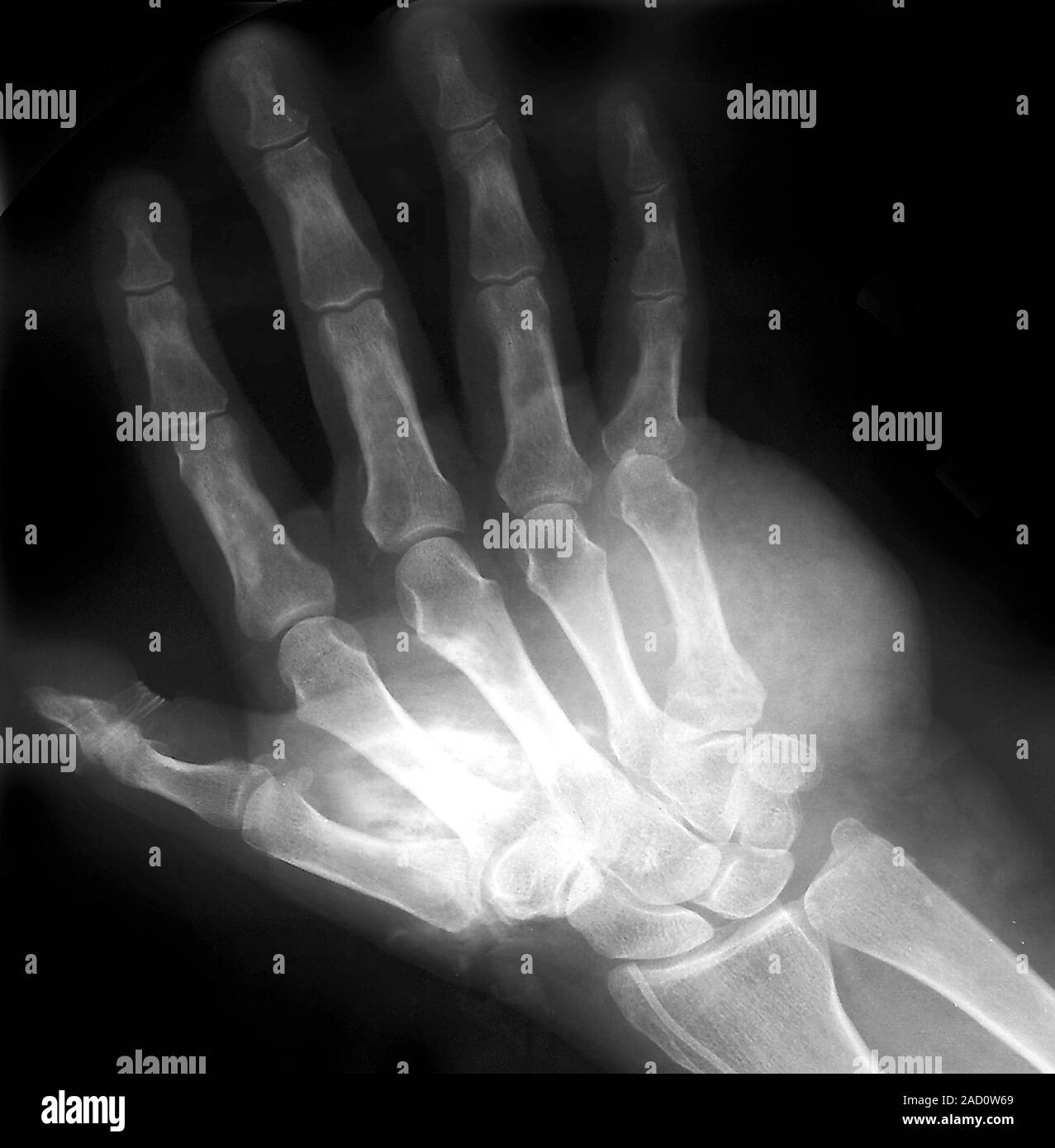 Hand tumour. X-ray of a section through the swollen and distorted left ...
