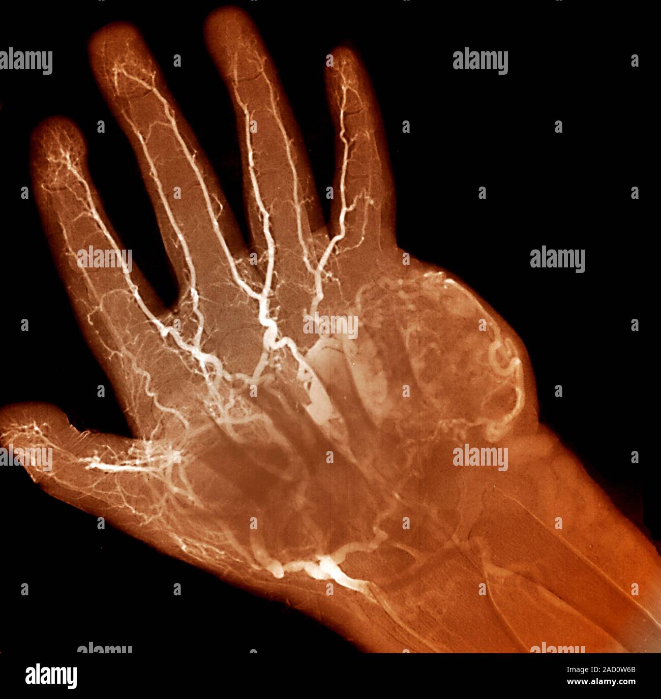 Hand tumour, X-ray. Coloured angiogram of a section through the swollen ...