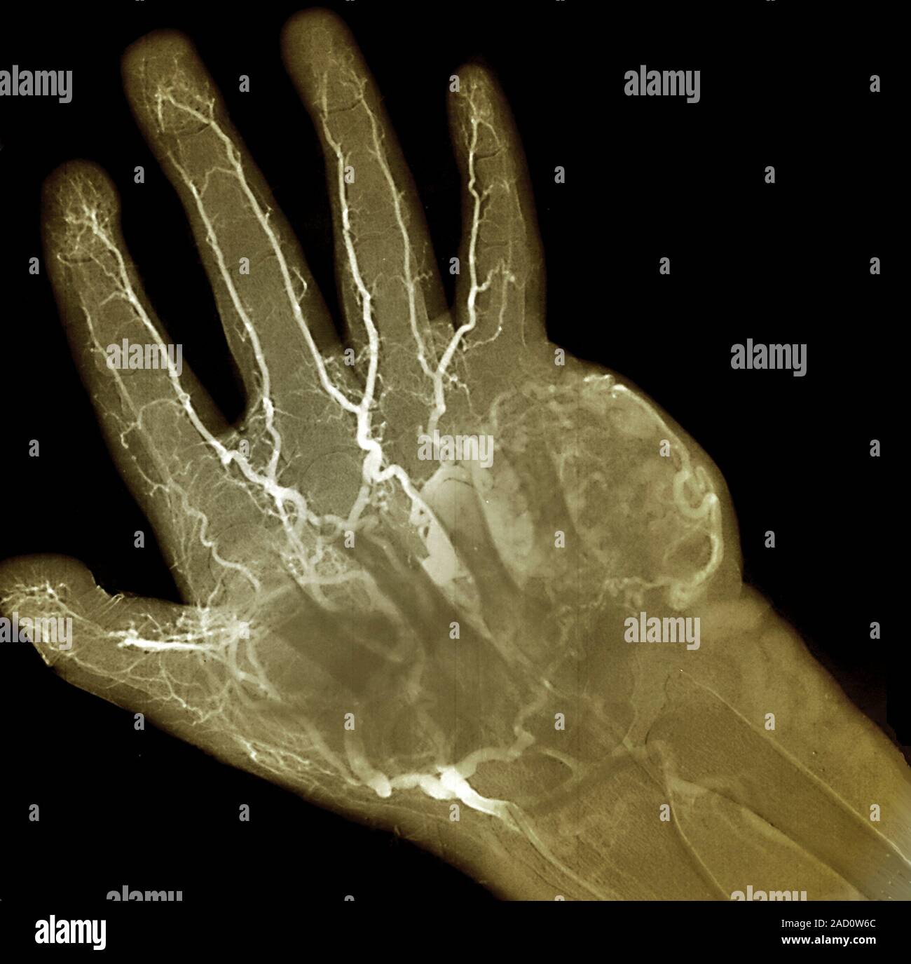 Hand tumour, X-ray. Coloured angiogram of a section through the swollen ...