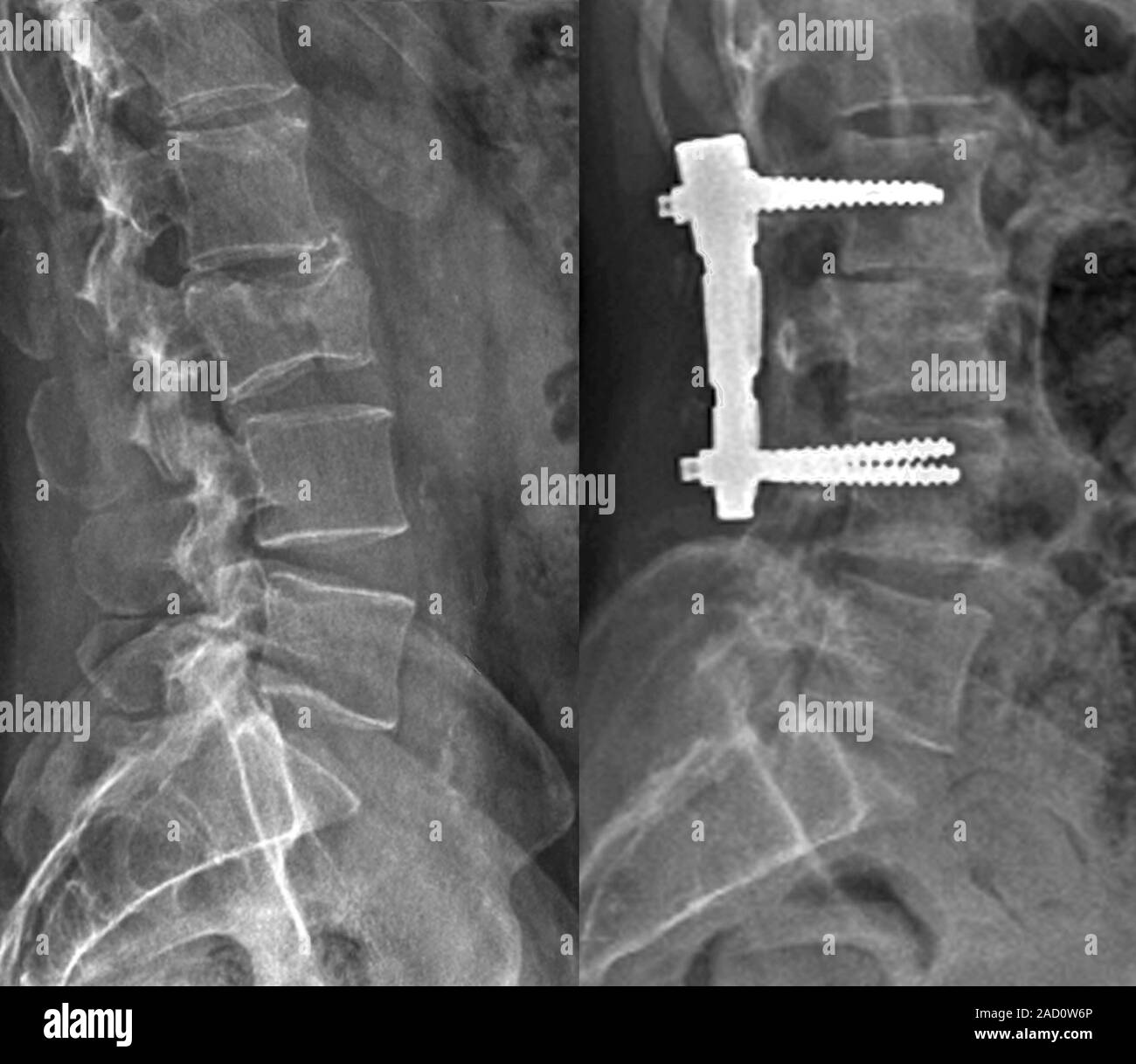 Pinned backbone. X-rays of a section through the lumbar spine of a 34 ...