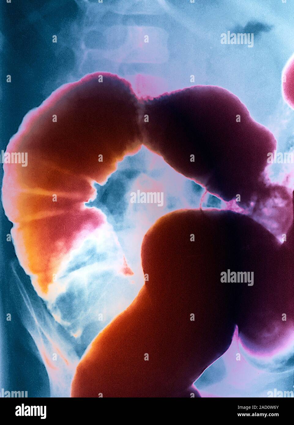 Intussusception of the intestines. Coloured barium X-ray of a section ...
