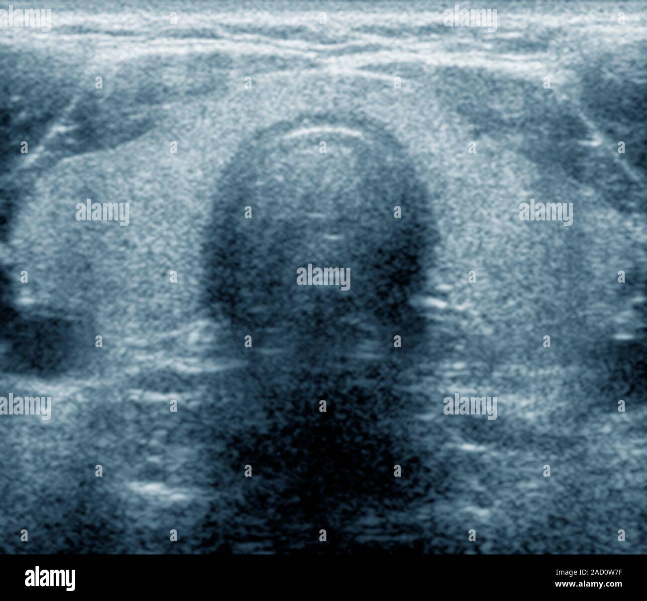 Normal thyroid gland. Ultrasound image of the throat of a healthy 40 ...