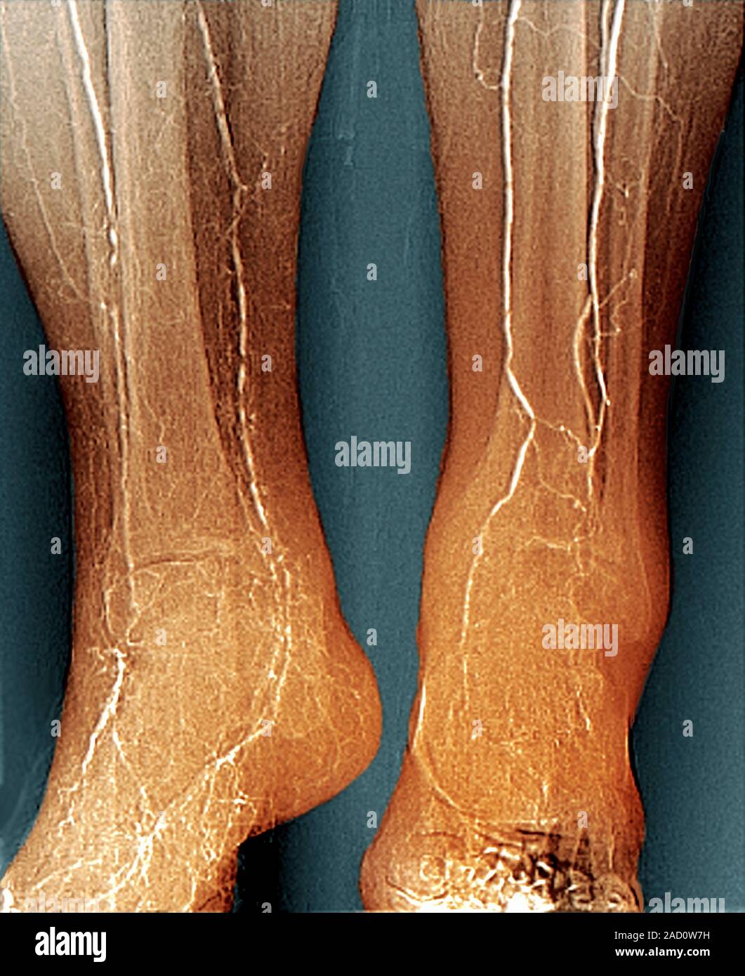 Arteritis in diabetes, X-ray. Coloured angiogram of a section through ...