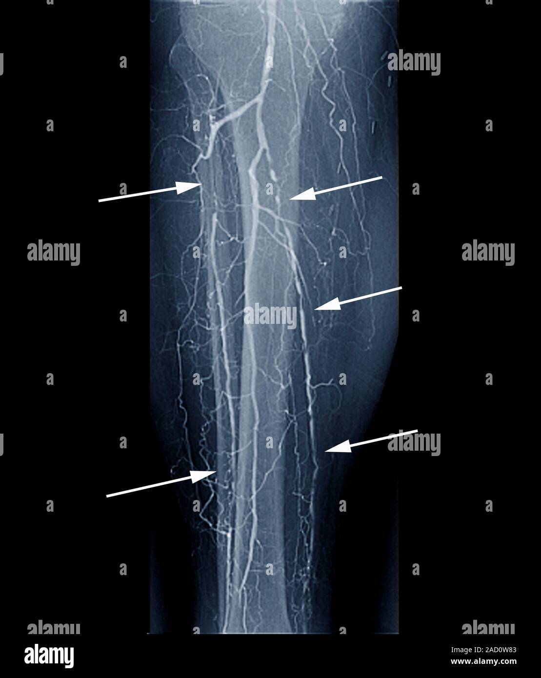 Arteritis in diabetes, X-ray. Angiogram of a section through the lower ...