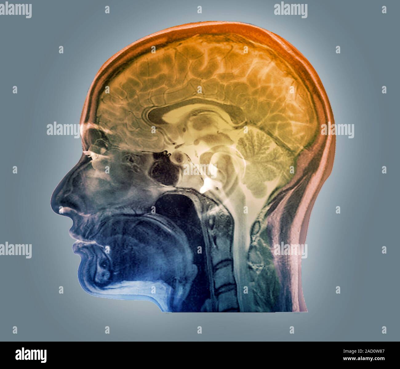 Auditory brain. Coloured magnetic resonance imaging (MRI) scan of the ...