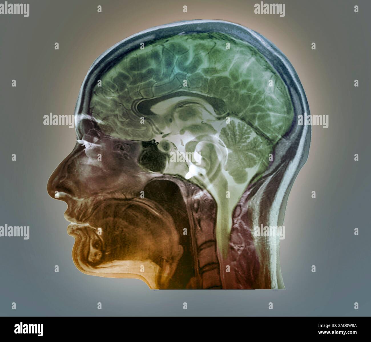 Auditory brain. Coloured magnetic resonance imaging (MRI) scan of the head of a healthy 30-year ...