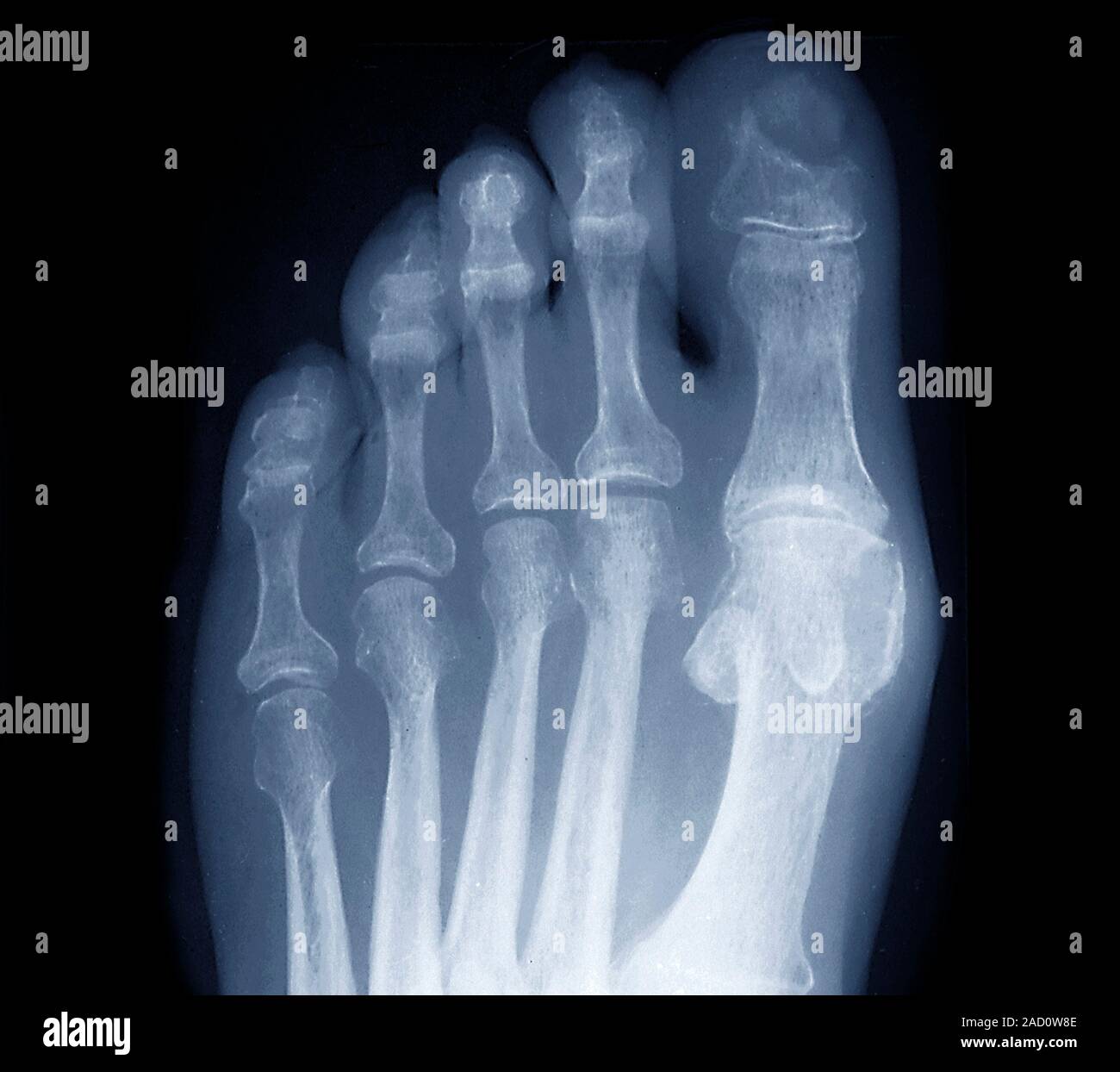 Osteonecrosis in diabetes. X-ray of a section through the left foot of ...