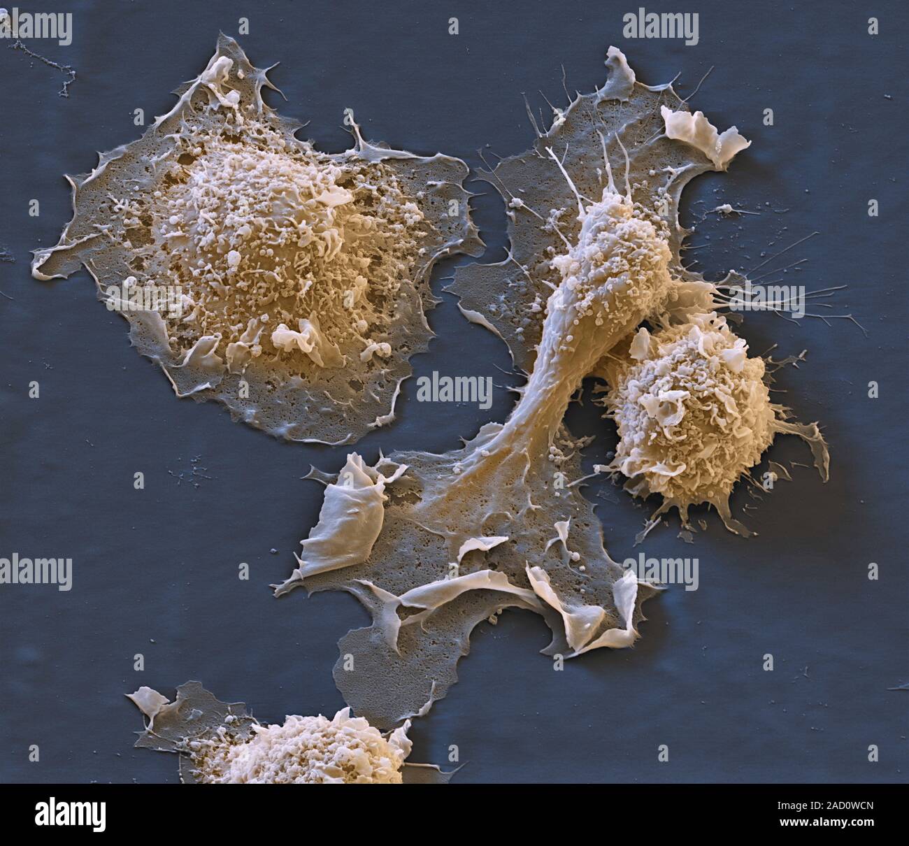 Mast cells, coloured scanning electron micrograph (SEM). Mast cells are ...