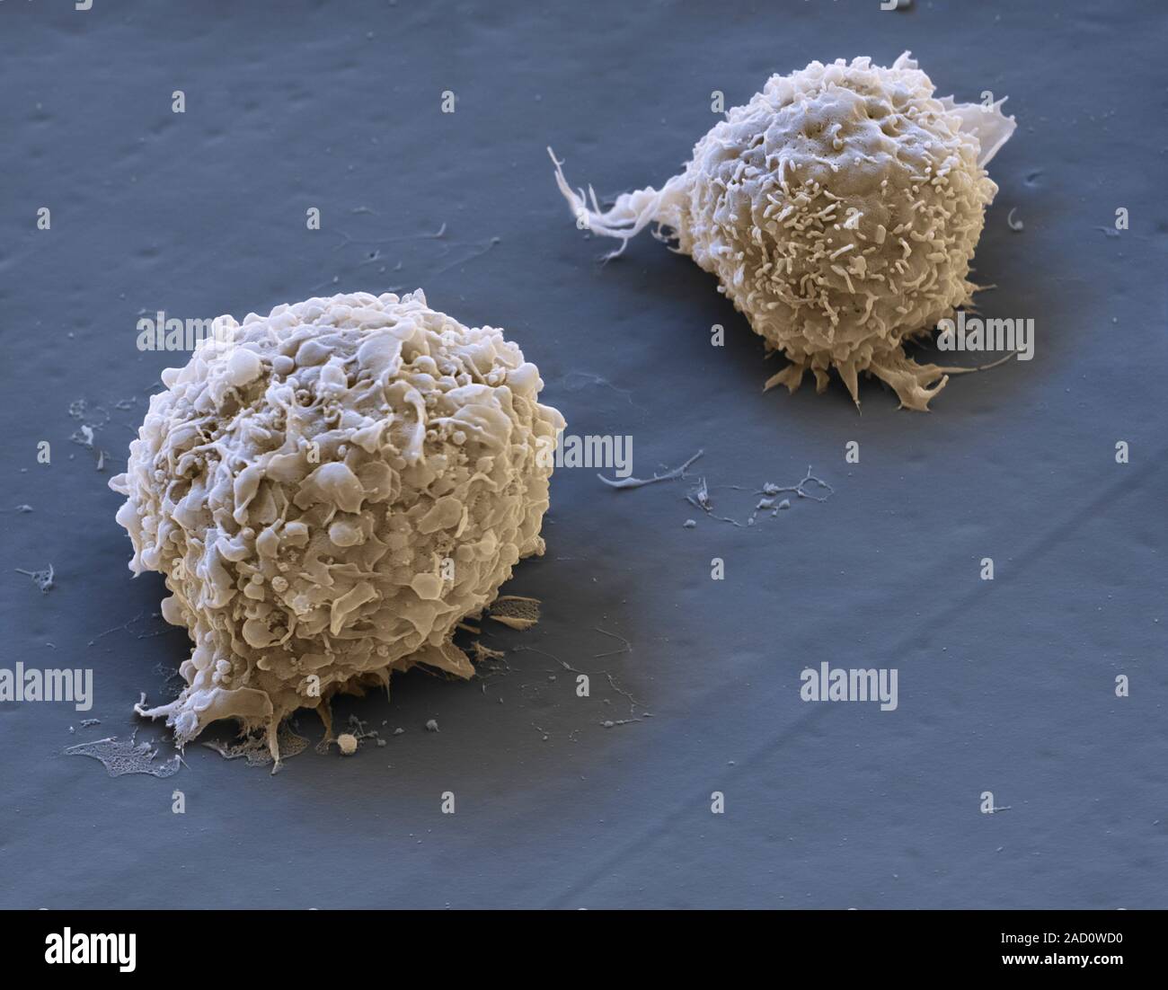 Mast cells, coloured scanning electron micrograph (SEM). Mast cells are ...