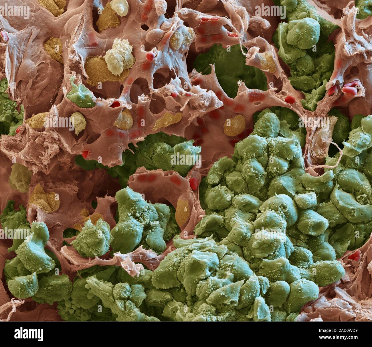 Lung cancer. Coloured scanning electron micrograph (SEM) of a section ...