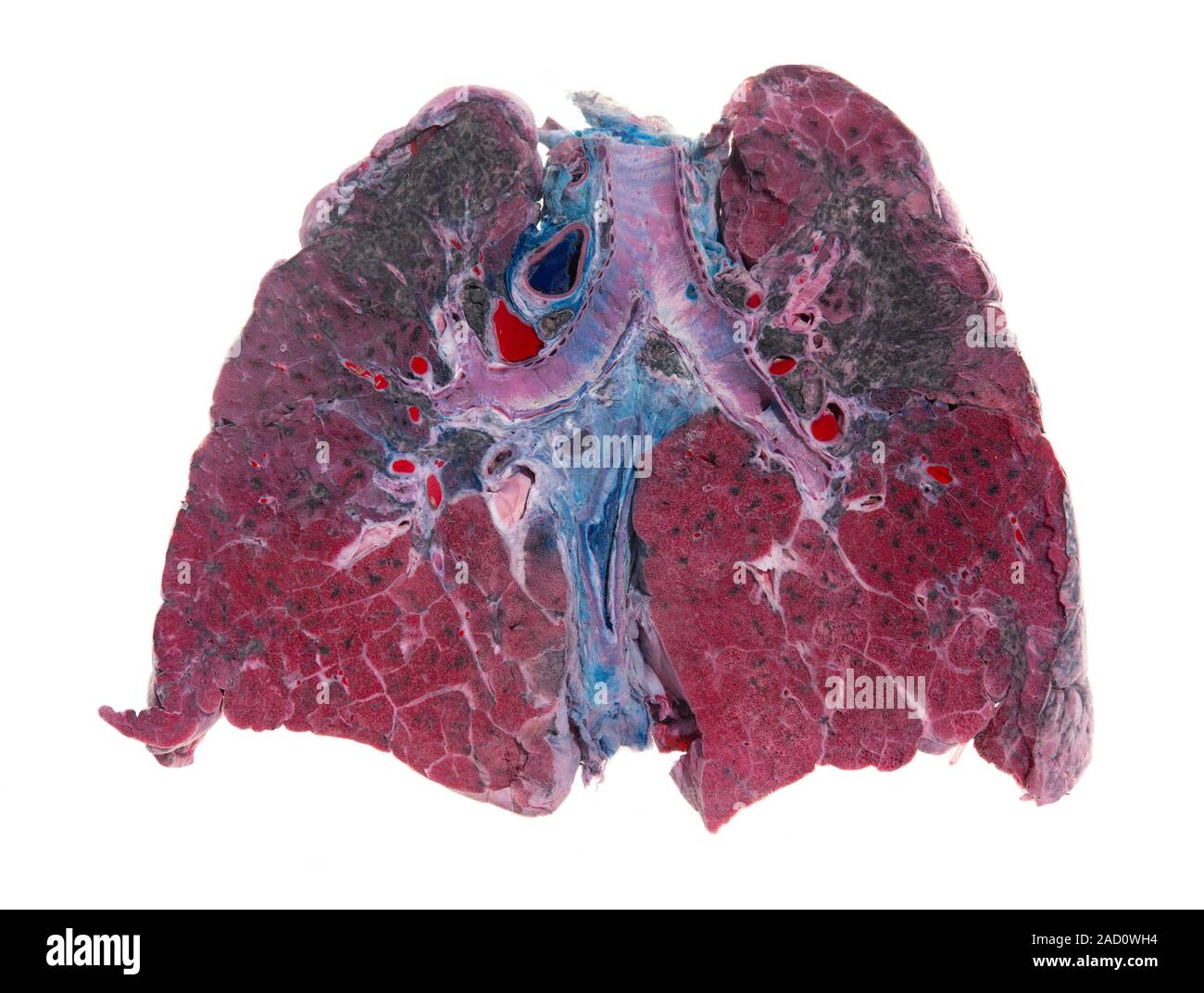 Silicosis of the human lung. An acquired disease of the lungs arising ...