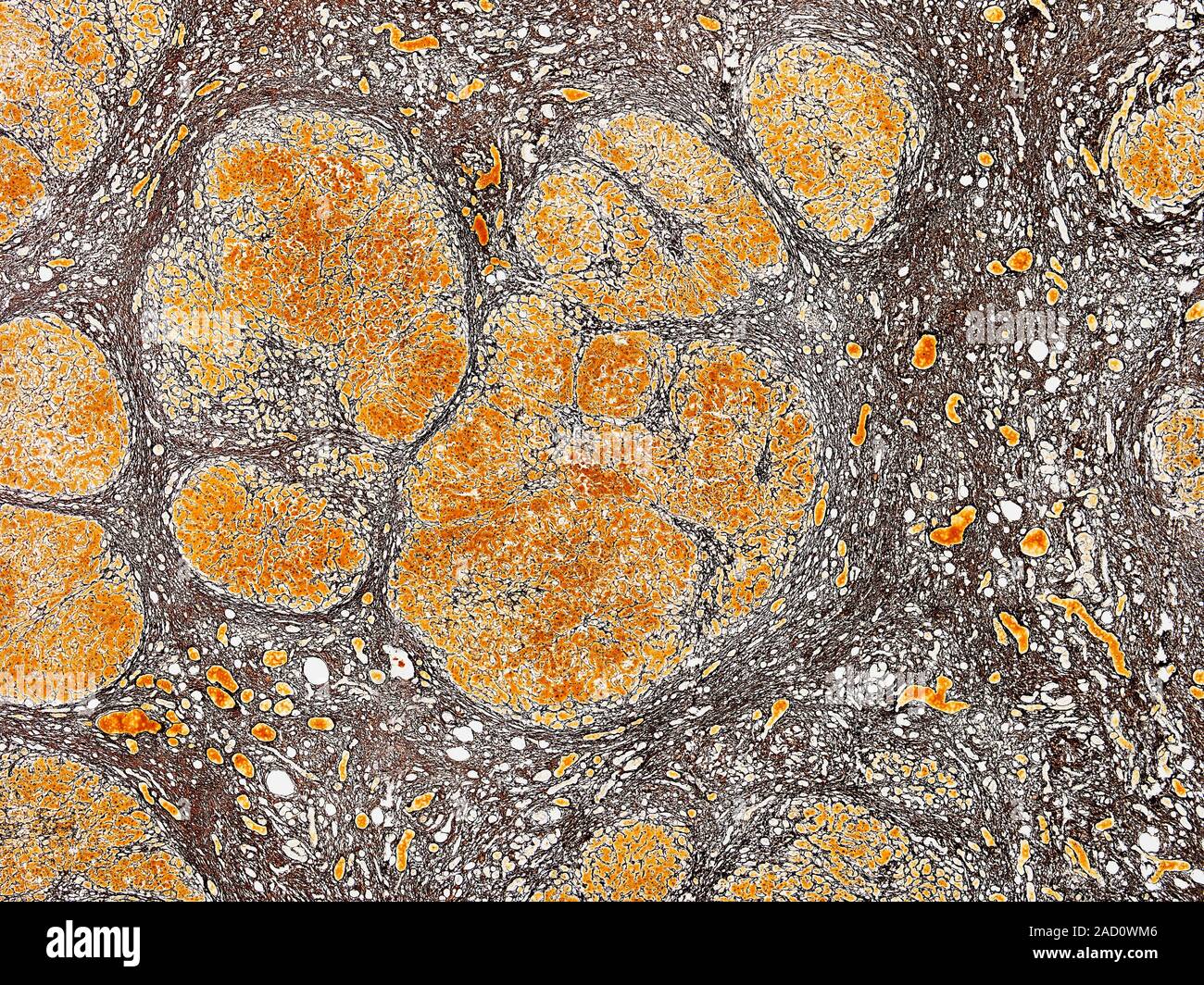 Light microscopy of cirrhosis of the liver. Much of the normally highly ...