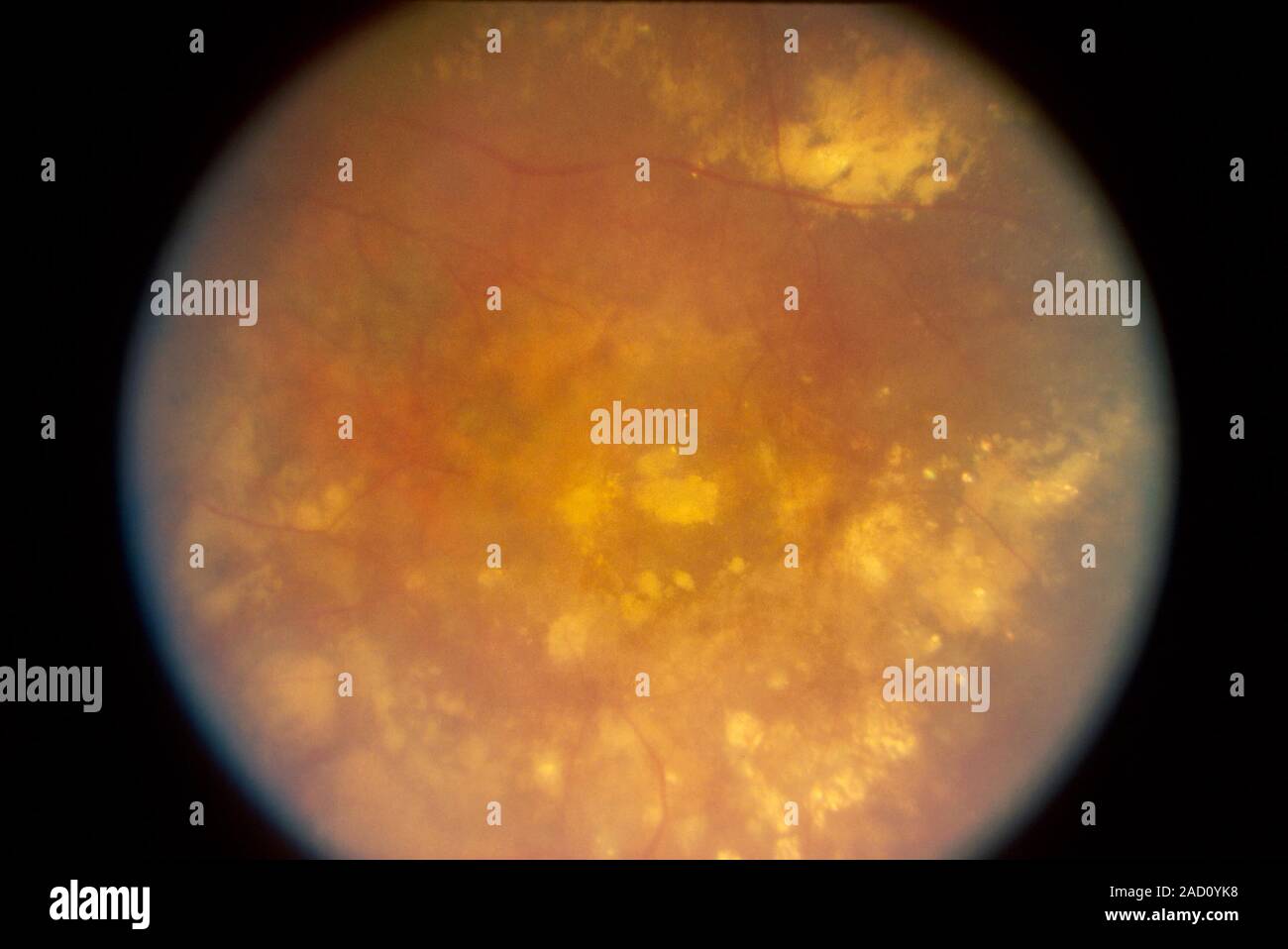 Macular degeneration, fundus photograph. View of the retina on the ...
