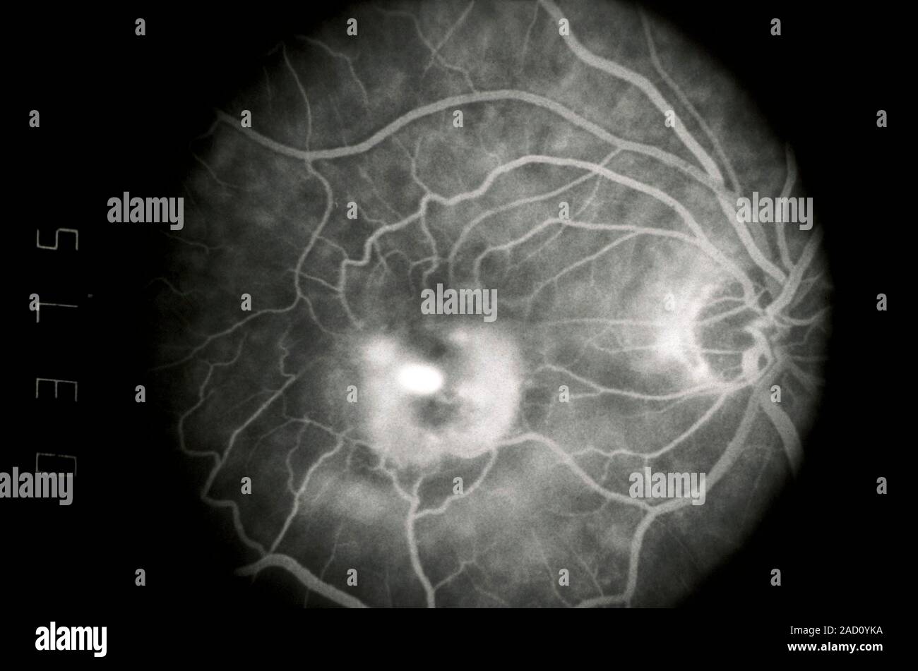 Macular degeneration, fundus photograph. View of the retina on the ...
