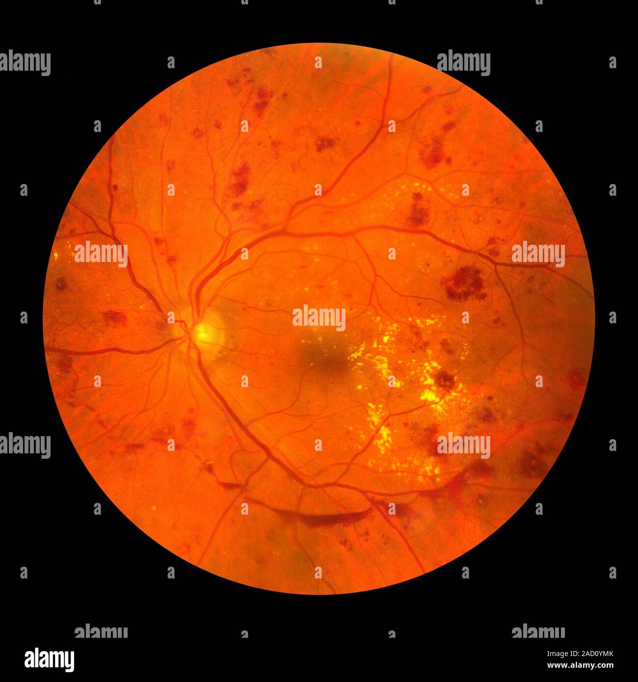Macular oedema. Fundus photograph of the retina on the interior surface ...