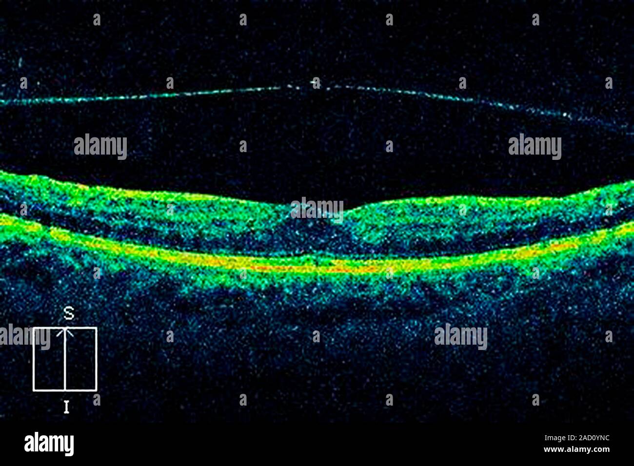 Vitreous detachment of the eye. Optical coherence tomography (OCT) scan ...