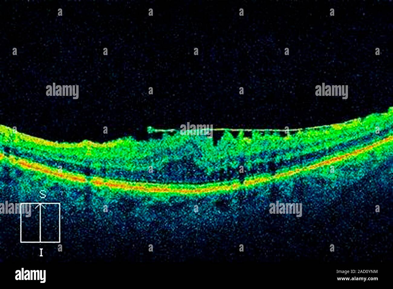 Epiretinal membrane. Optical coherence tomography (OCT) scan of a ...