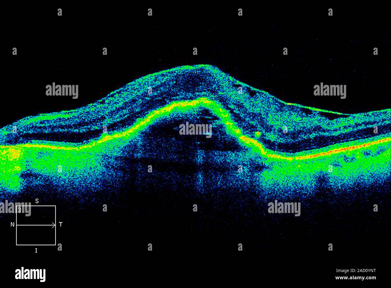 Macular degeneration. Optical coherence tomography (OCT) scan of a ...