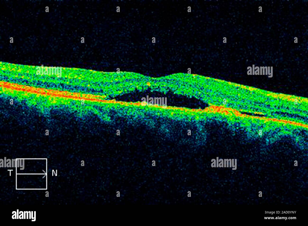 Macular degeneration. Optical coherence tomography (OCT) scan of a ...