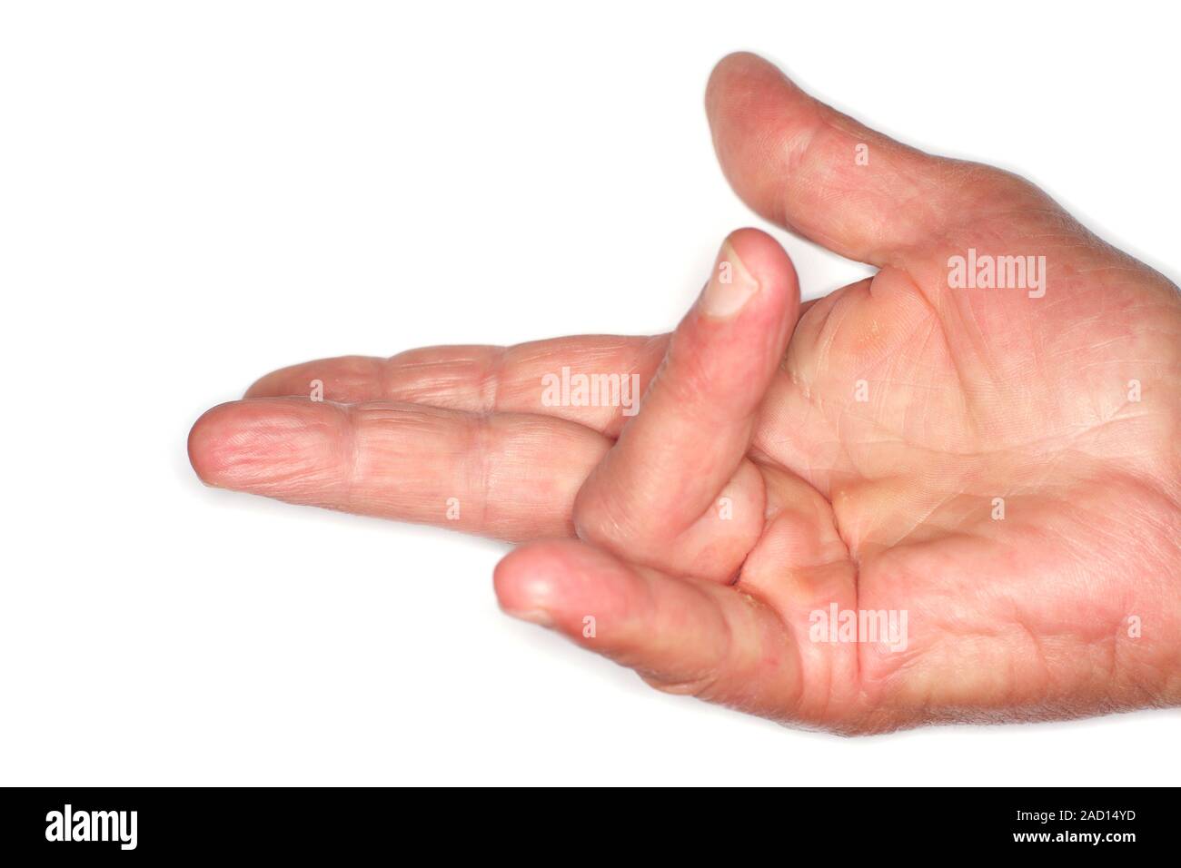 Dupuytren's contracture in a patient's hand. This condition causes one ...